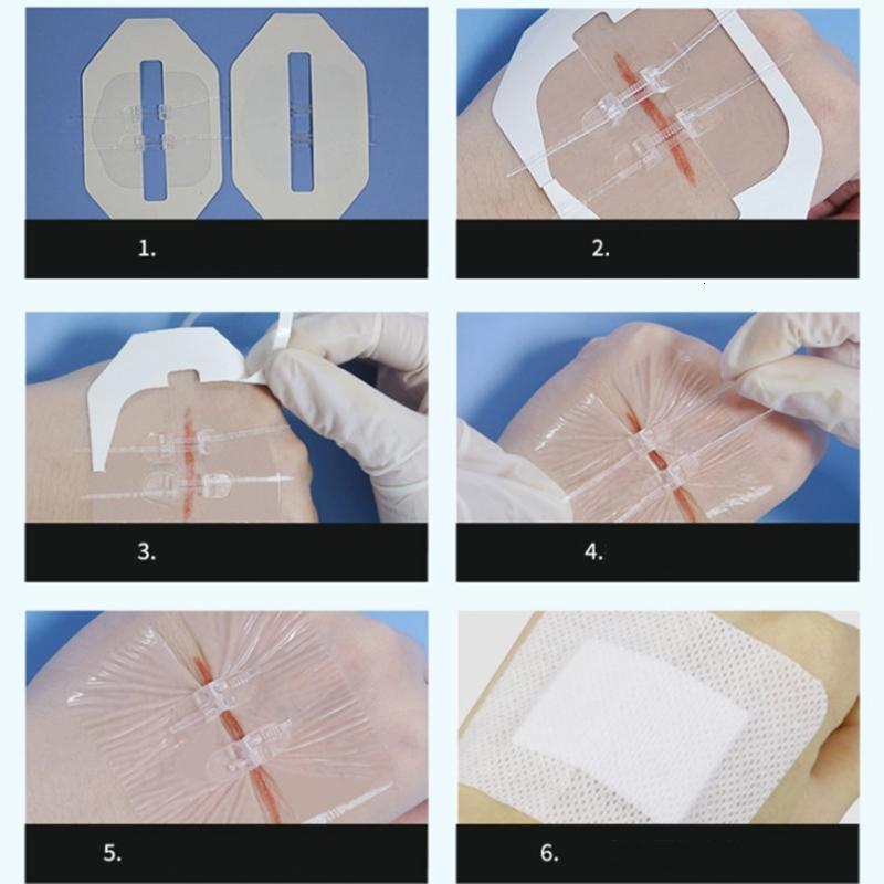 Zipper Stitches Sutures, Butterfly Zipstitch Laceration Zipper Painless ...