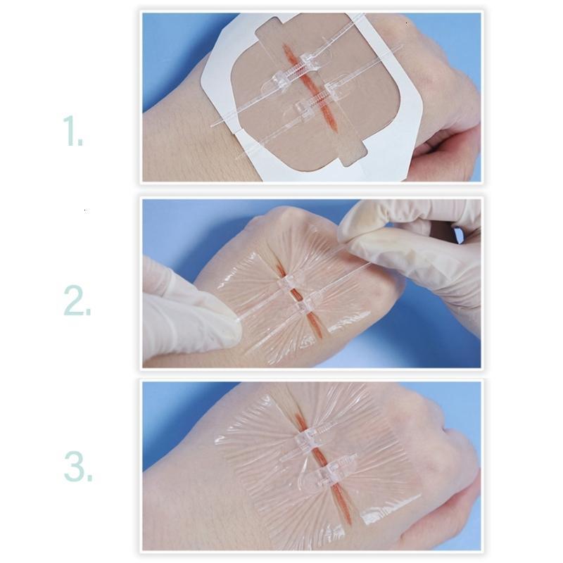 Wound Closures Device Zipper Stitches Sutures, Zipstitch Laceration ...