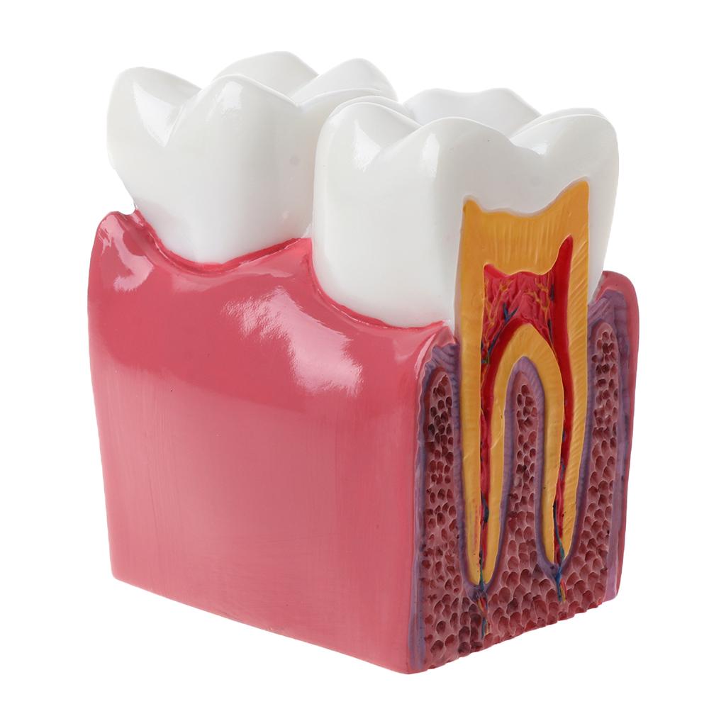 6 Times Dental Caries Comparation Anatomy Teeth Model for Dental ...